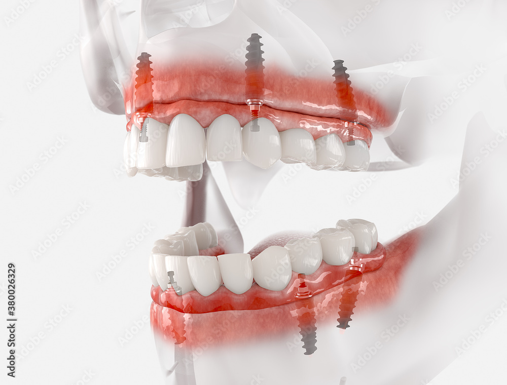 Mandibular and Maxillary prosthesis Stock Illustration | Adobe Stock
