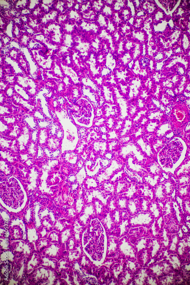 Compression atrophy of human kidney Stock Photo | Adobe Stock