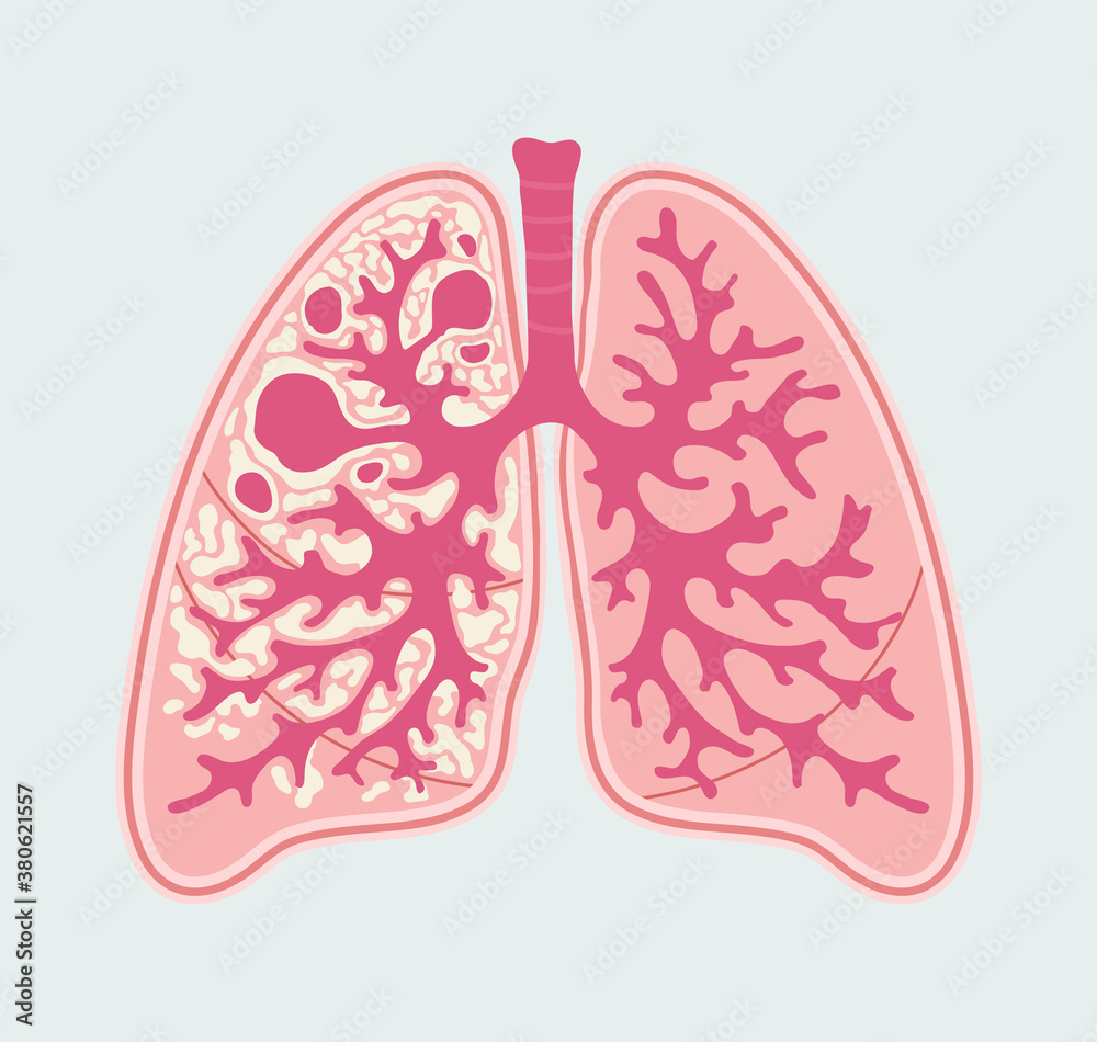 Tuberculosis in lung of human. Respiratory diseases - T.B. - Anatomical ...