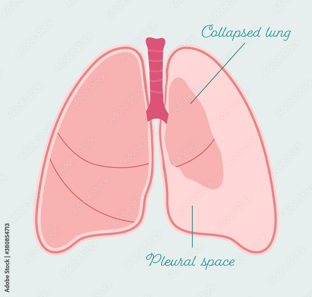 Collapsed lung, pneumothorax - anatomical scheme in hand drawn style ...