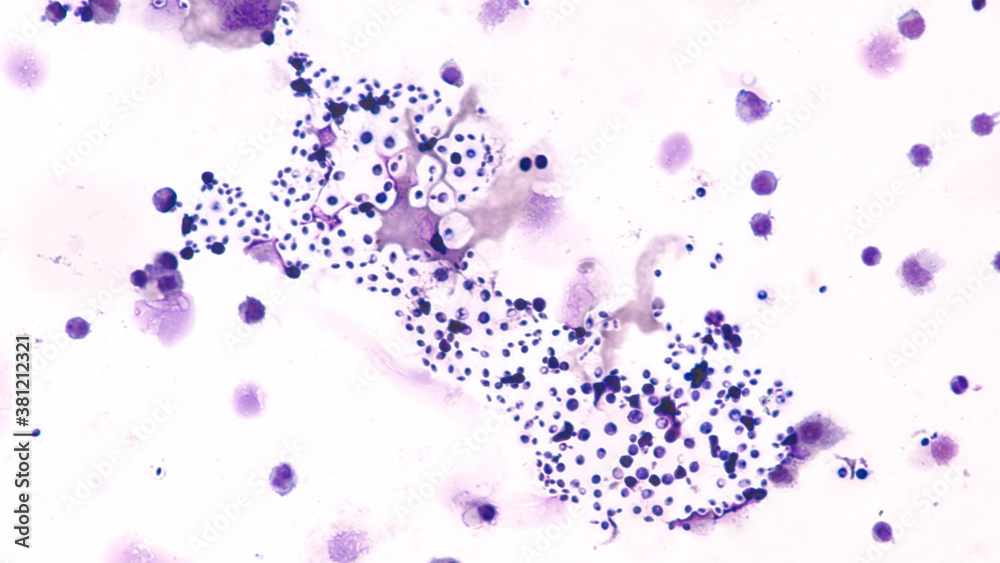 Stock Foto „cerebrospinal Fluid Csf Cytology From An