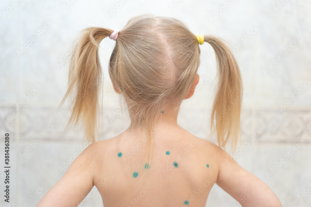 Chickenpox disease. Small girl sick on his back . Chickenpox virus ...