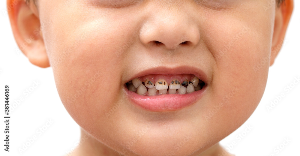 Tooth decay of children who like to eat sweets candy. And doesn't like ...