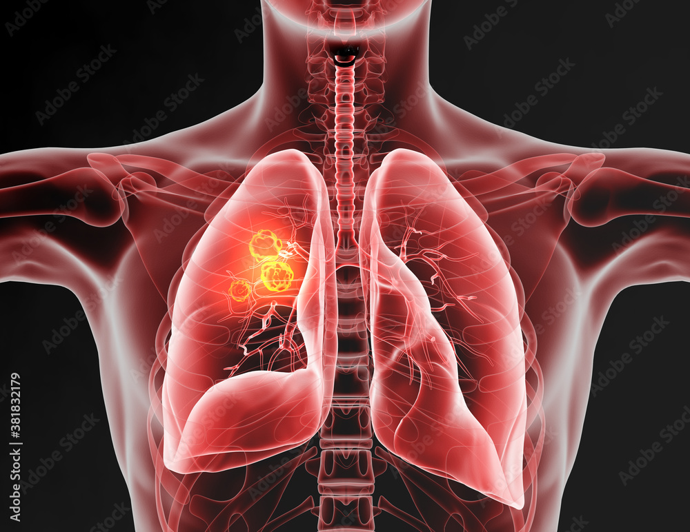 Lung cancer, medically accurate 3D illustration Stock Illustration ...