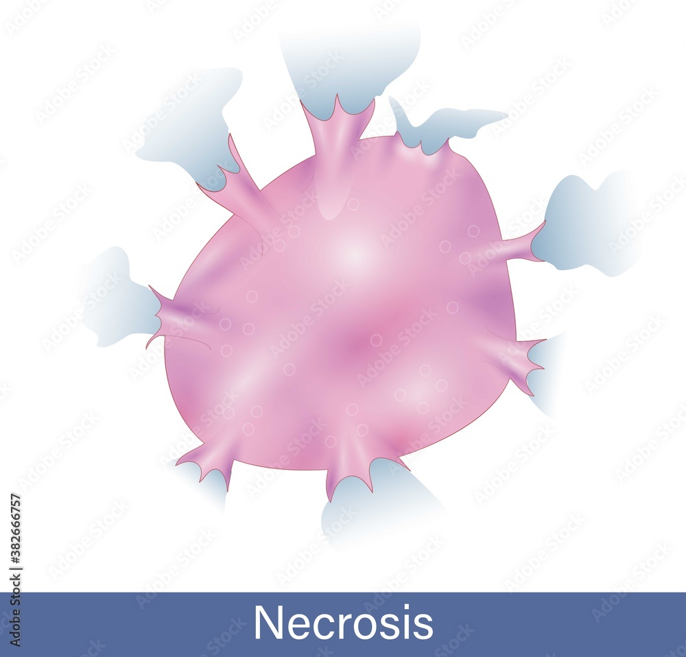 Mechanism of Necrosis. Cell bursting. Plasma membrane rupture. Cell ...
