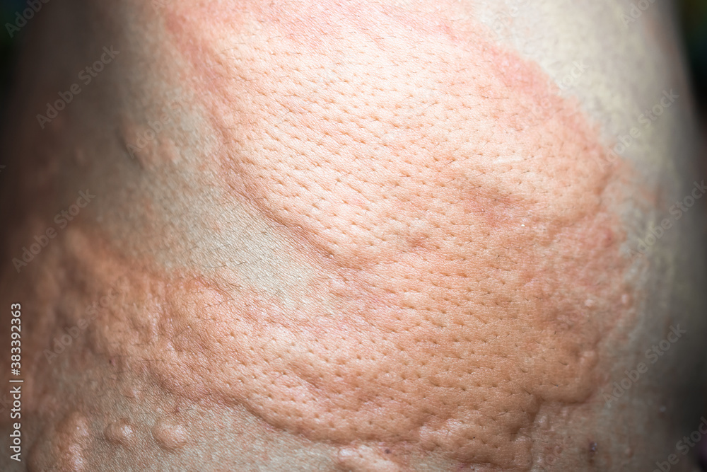 urticaria on skin. rashes, of which urticaria and toxic erythema are ...