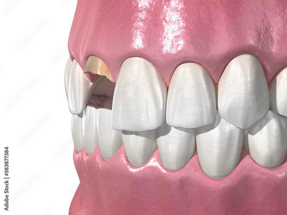 Broken central incisor tooth. Medically accurate 3D illustration of ...