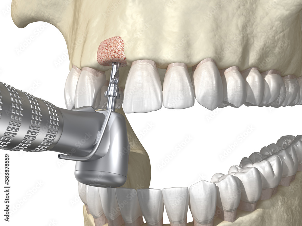Drilling of the bone for dental implant placement. Medically accurate ...