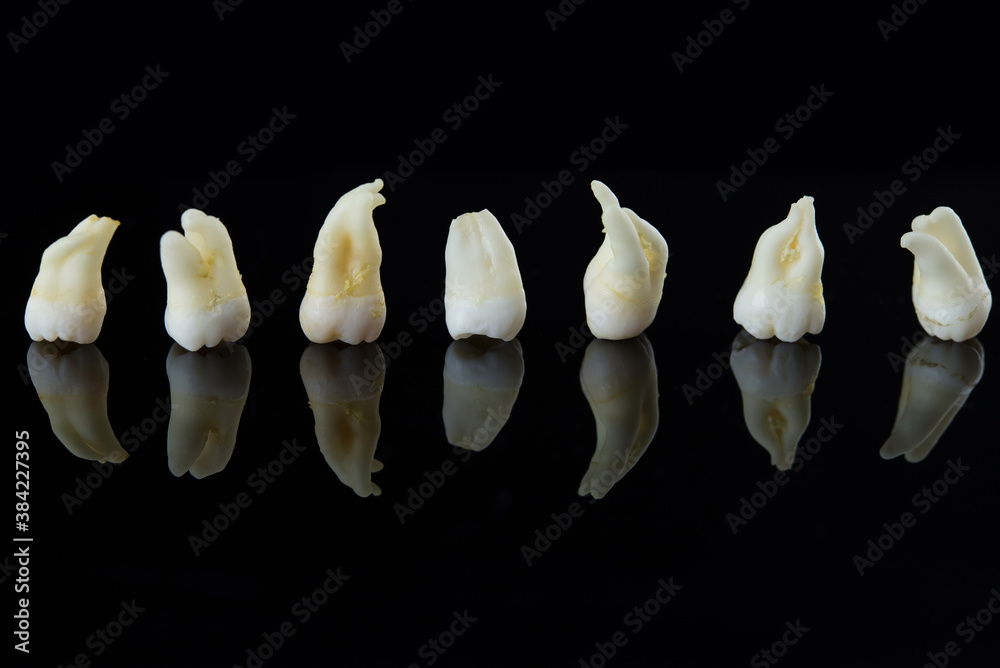 Removed diseased human teeth stacked in a row on a black background ...