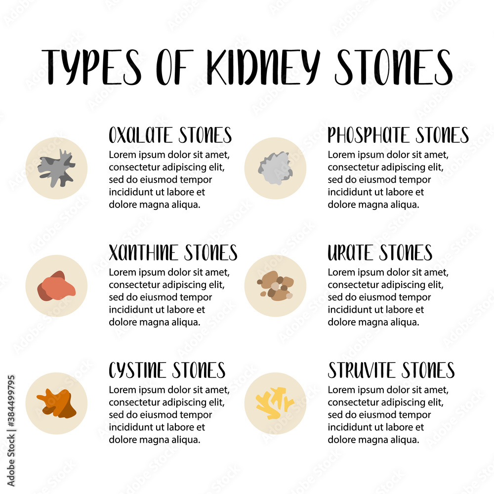 Types of kidneys stones. Oxalate, phosphate, xanthine, urate, cystine ...
