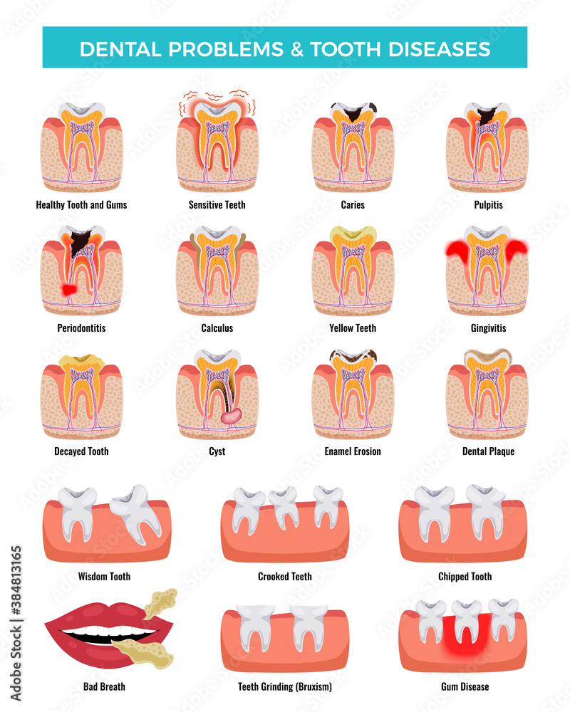Dental Problems Diseases Infographic Set Stock Vector | Adobe Stock