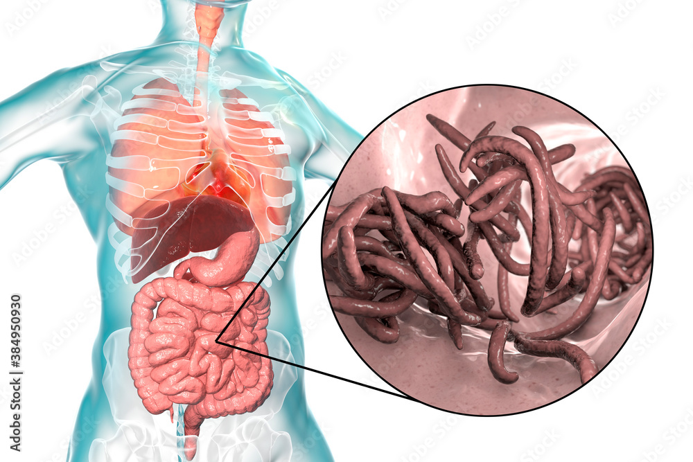 Parasitic worms in human small intestine Stock Illustration | Adobe Stock