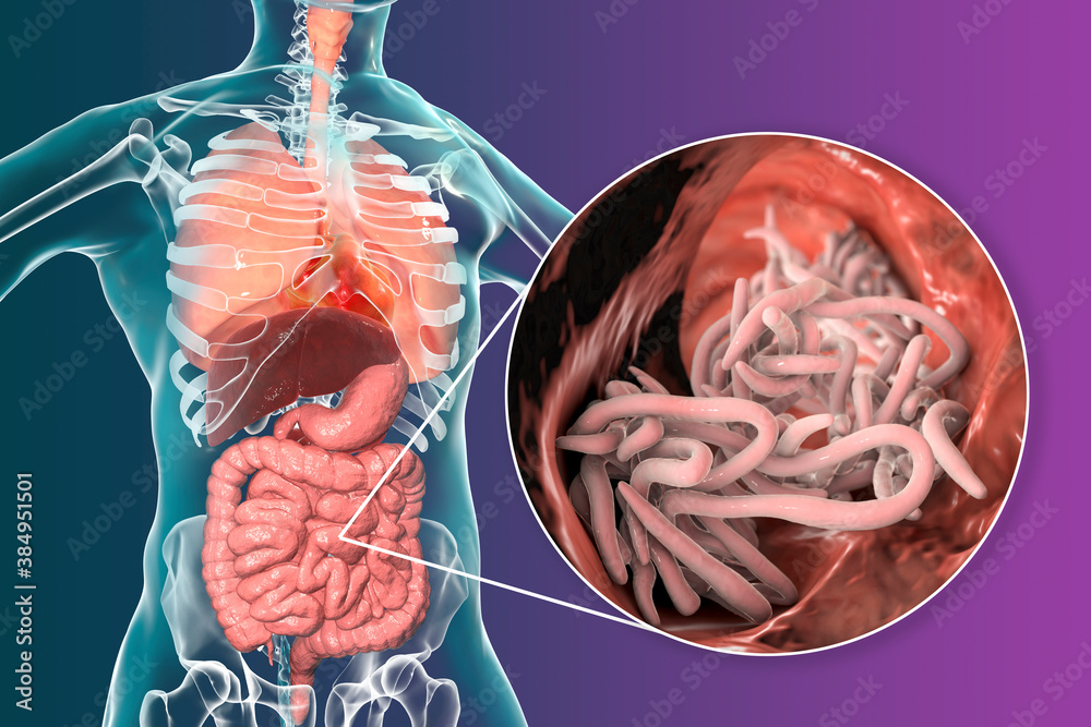 Parasitic worms in human small intestine Stock Illustration | Adobe Stock