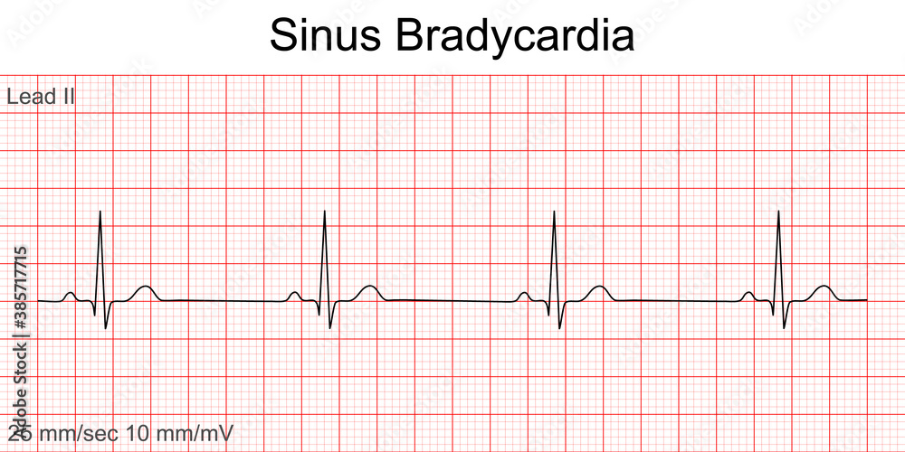 Electrocardiogram show Sinus bradycardia pattern. Cardiac fibrillation ...