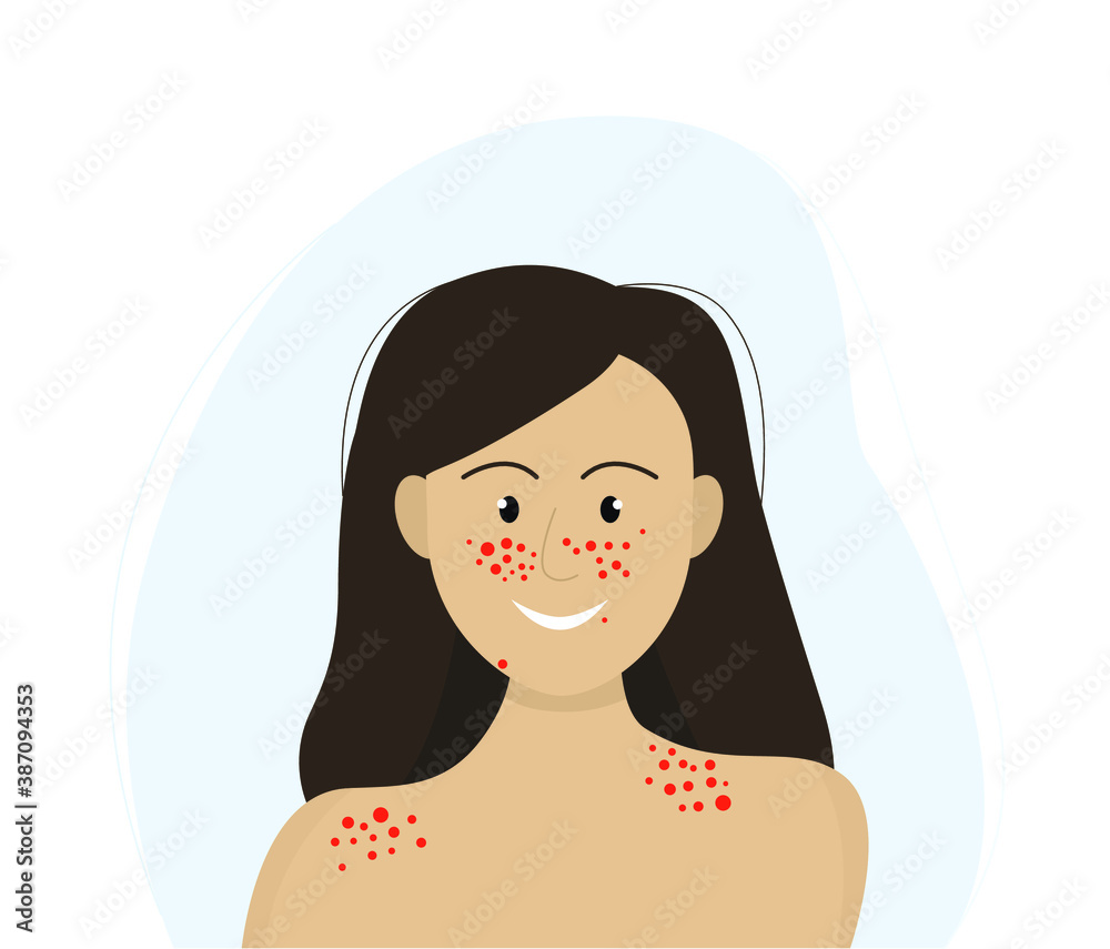young girl with skin rashes on the face, a symptom of lupus ...