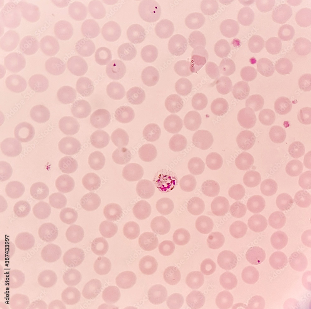 Under 100X light microscope, human parasite on thin film of blood smear ...