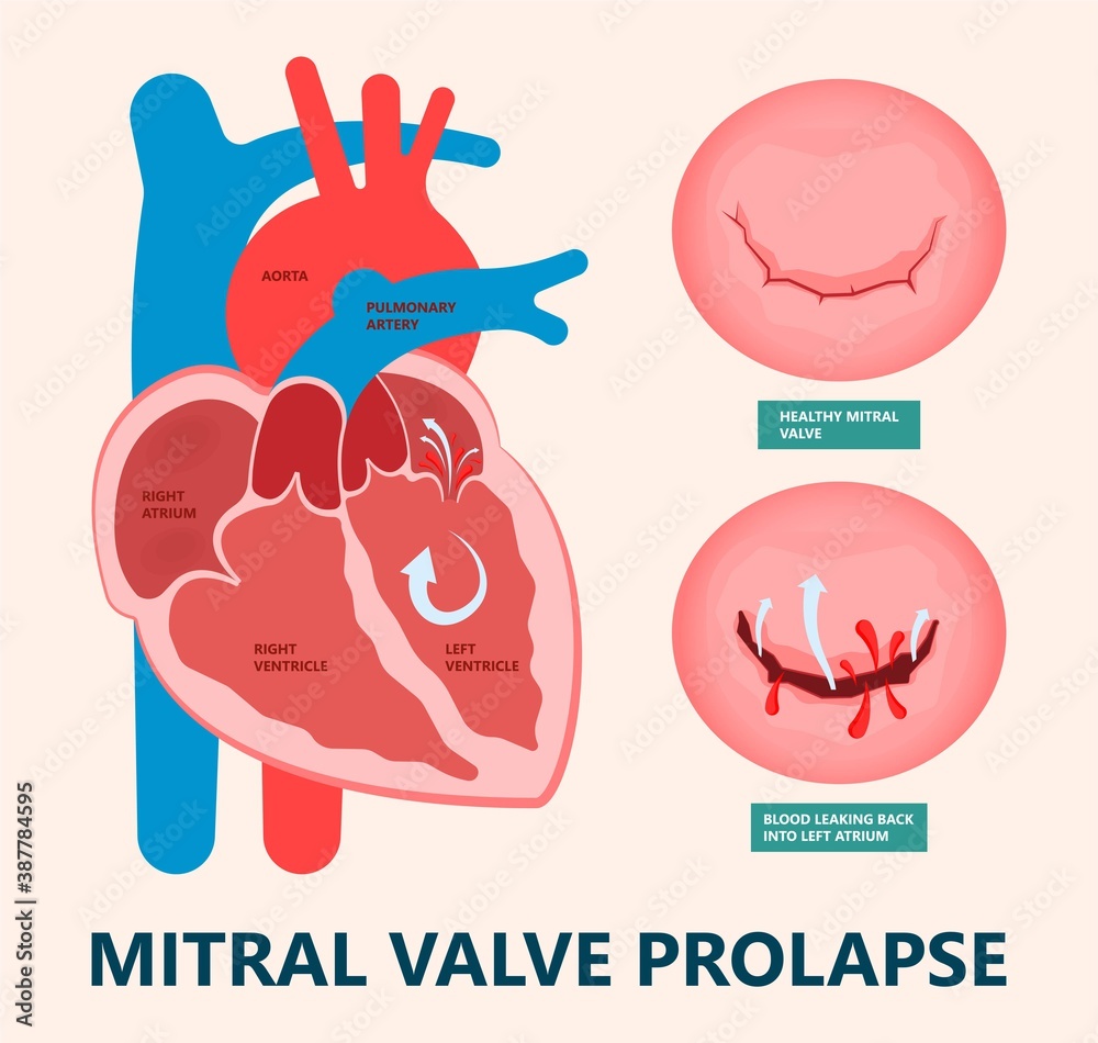 Vector de Stock Cath Lab Atrial Septal Defect Tetralogy of Fallot ...