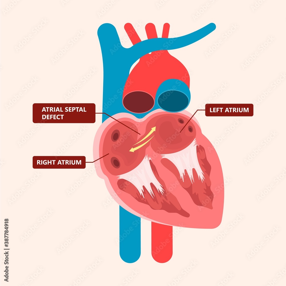 Vector de Stock Cath Lab Atrial Septal Defect Tetralogy of Fallot ...