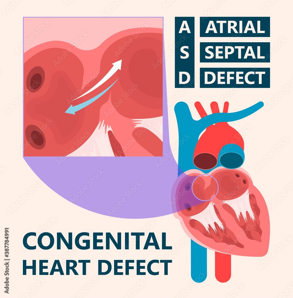 Cath Lab Atrial Septal Defect Tetralogy of Fallot Patent Foramen Ovale ...