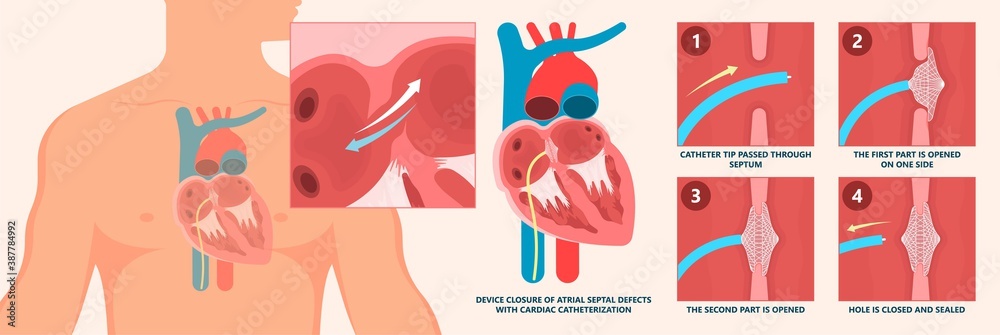 Cath Lab Atrial Septal Defect Tetralogy of Fallot Patent Foramen Ovale ...