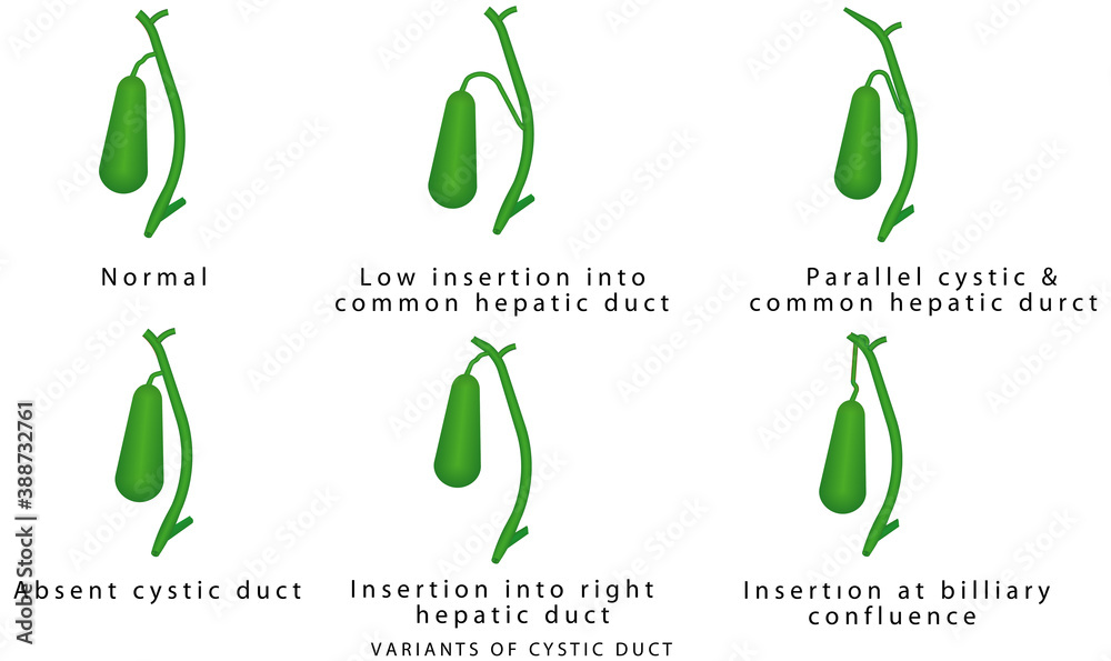 Стоковое векторное изображение «Variants of cystic duct. Common ...