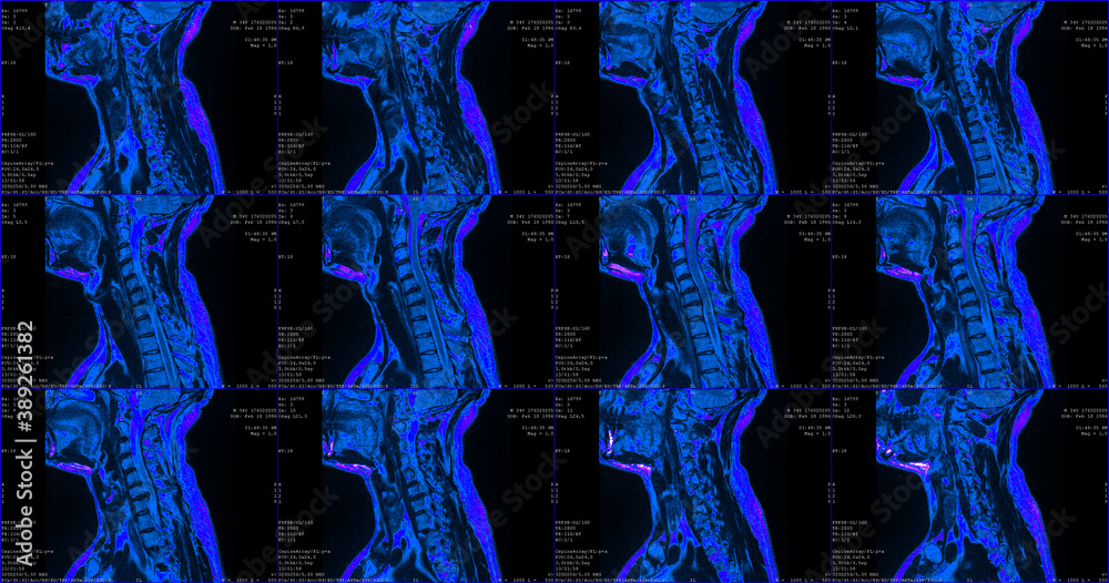 Photo Stock set of 12 sagittal blue colored MRI scans of neck area of ...
