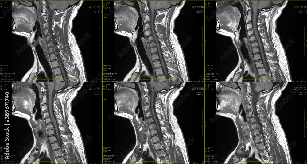 Photo Stock set of 6 sagittal MRI scans of neck area of caucasian 34 ...