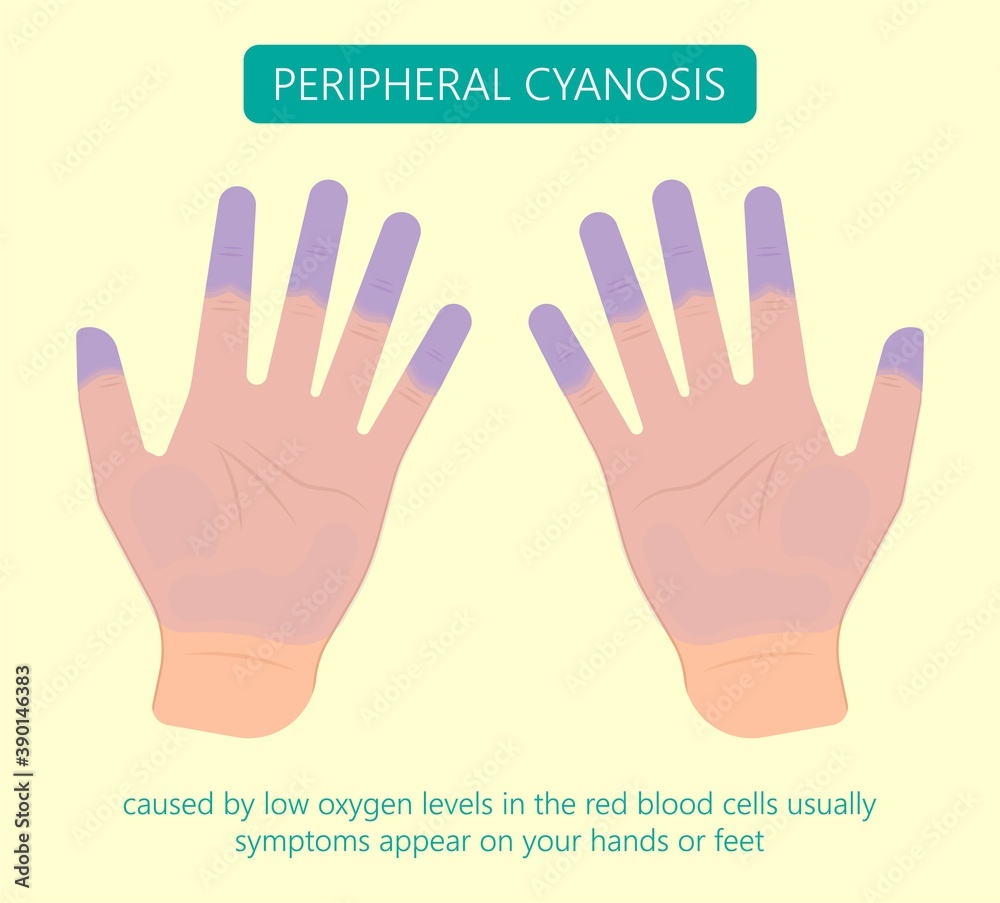 Стоковий вектор Peripheral cyanosis symptoms of low oxygen levels in ...