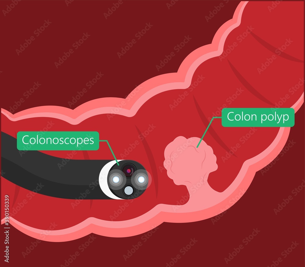 Polypectomy procedure to remove polyps from the colon medical Stock ...