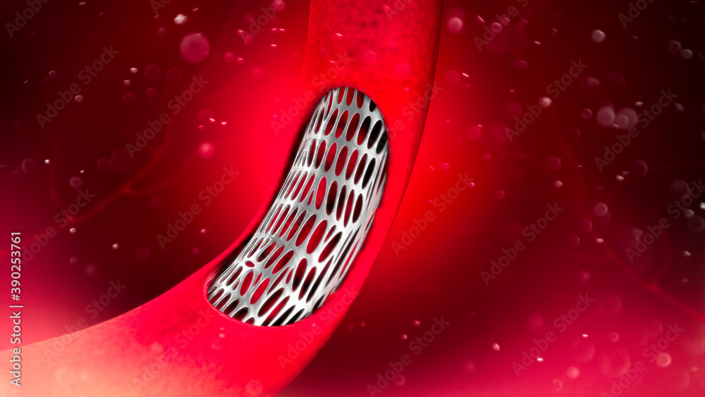 Coronary artery bypass surgery, is a surgical procedure to restore ...