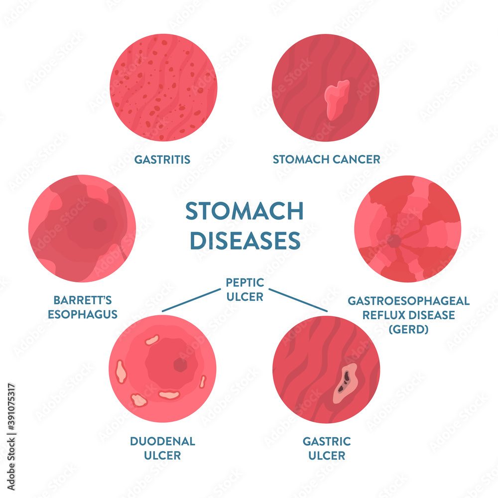 Types of stomach diseases detected by endoscopy diagnostics - gastritis ...