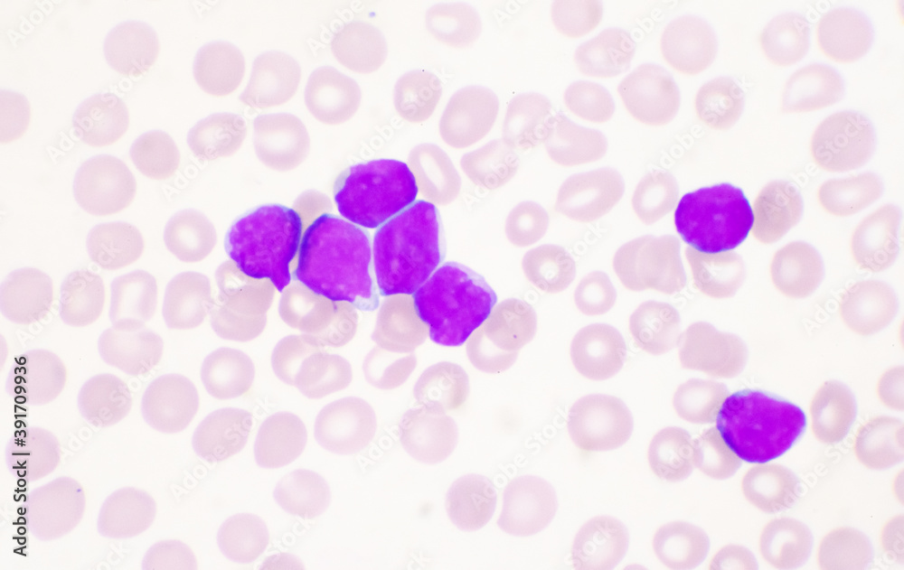 Moderate blast cell of white blood cells in blood smear. Stock Photo ...