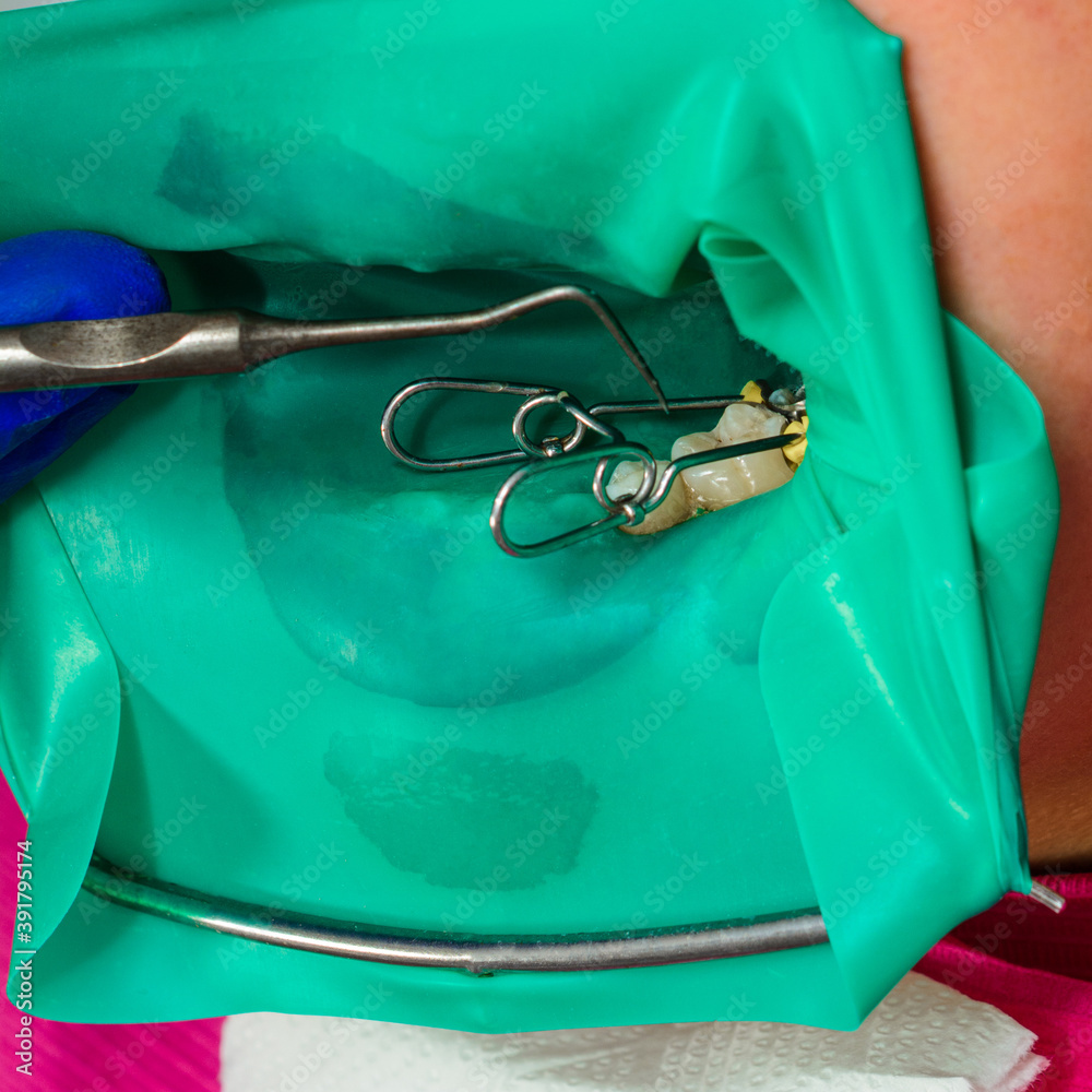 Dental restoration and polymerization of tooth composite materials, the ...