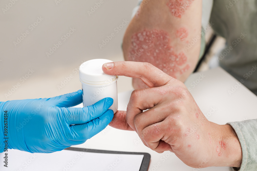 The dermatologist examines the skin of the patient the patient holds in ...