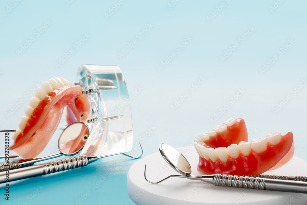 Teeth model showing an implant crown bridge model/ dental demonstration ...