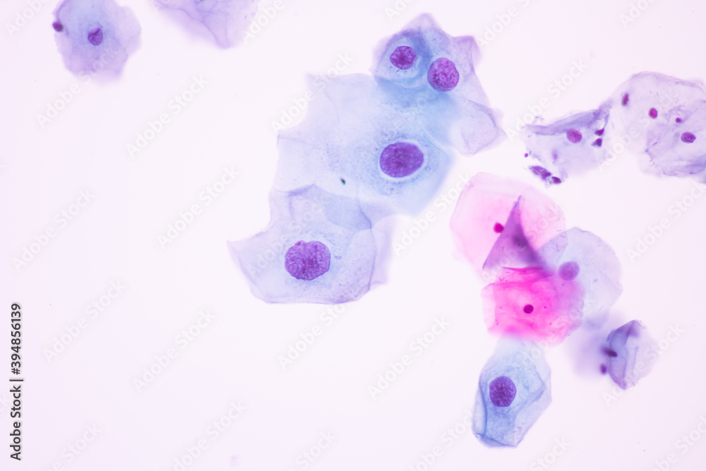View in microscopic of Abnormal human cervix cells.Squamous epithelium ...