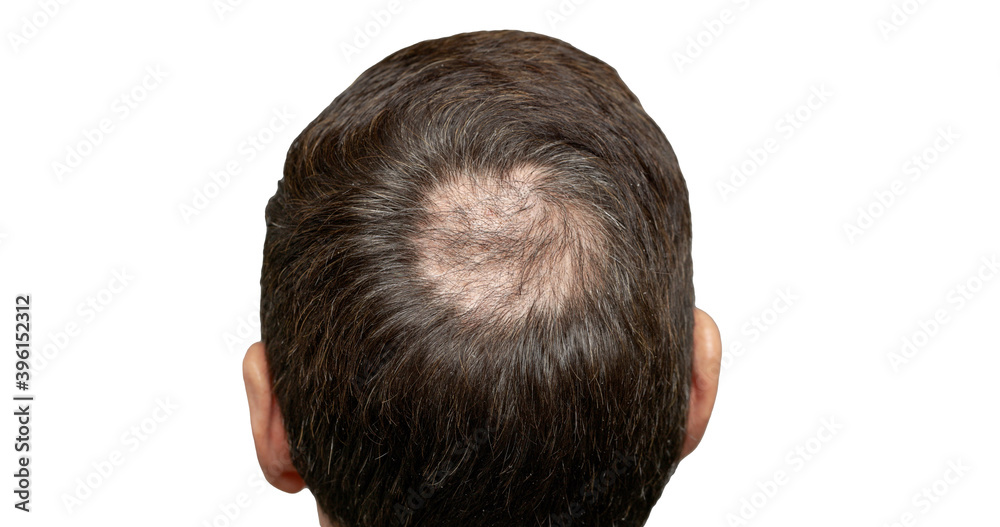 Fotografie Man with hair loss problems closeup, isolated. Alopecia ...