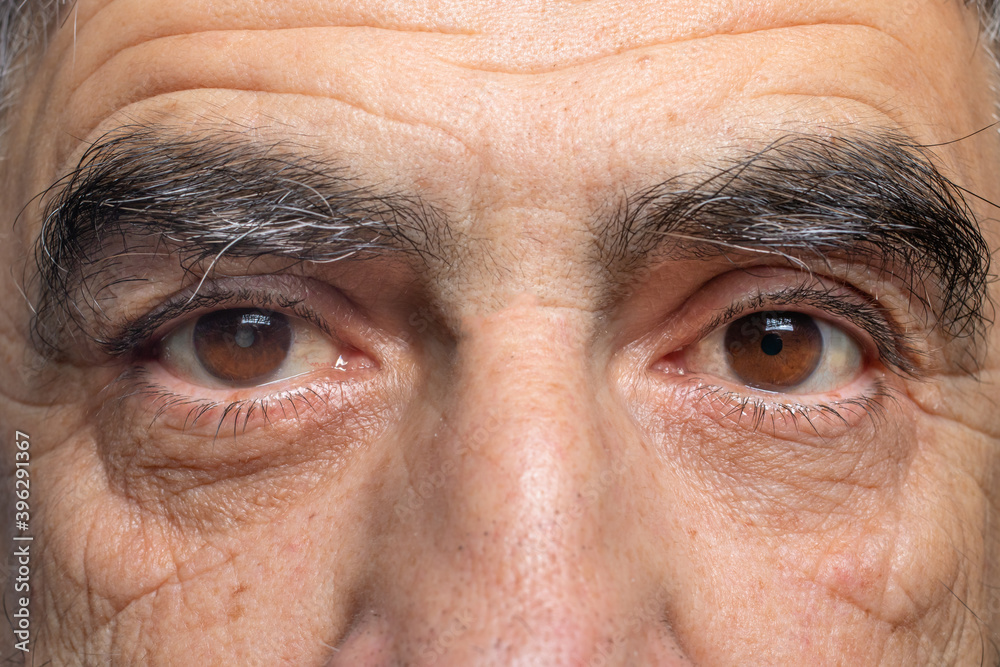 A man with cataracts is a disease of the lens of the human eye ...