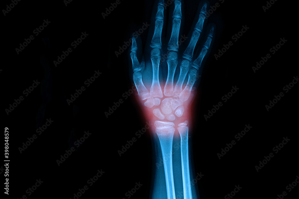 X-ray of hand bones, Represents inflammation of the muscles and wrist ...