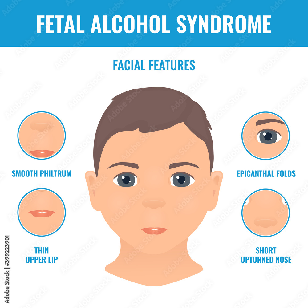 Facial features in a child with fetal alcohol syndrome. Foetal alcohol ...