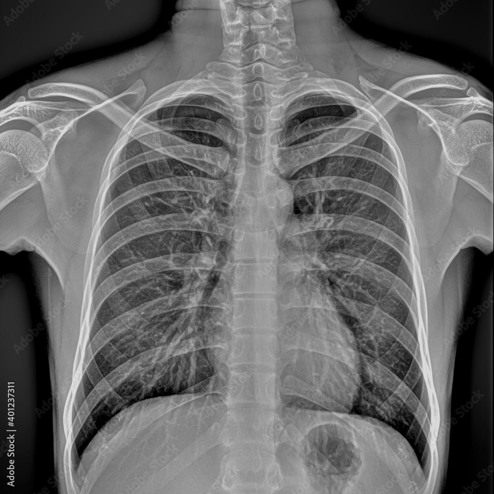 Chest radiography of a hospital patient Stock Photo | Adobe Stock