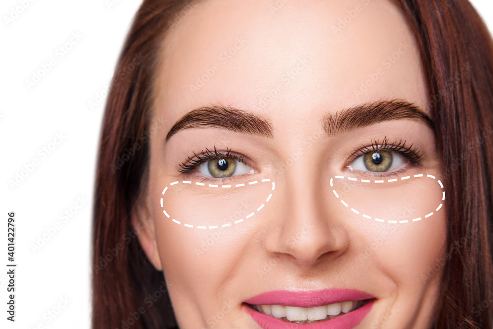 Female face with dotted area under eyes and near mouth. Plastic surgery ...