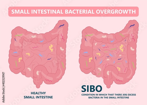 intestine bacteria gut pain eating IBS large fungal fungi tract H ...