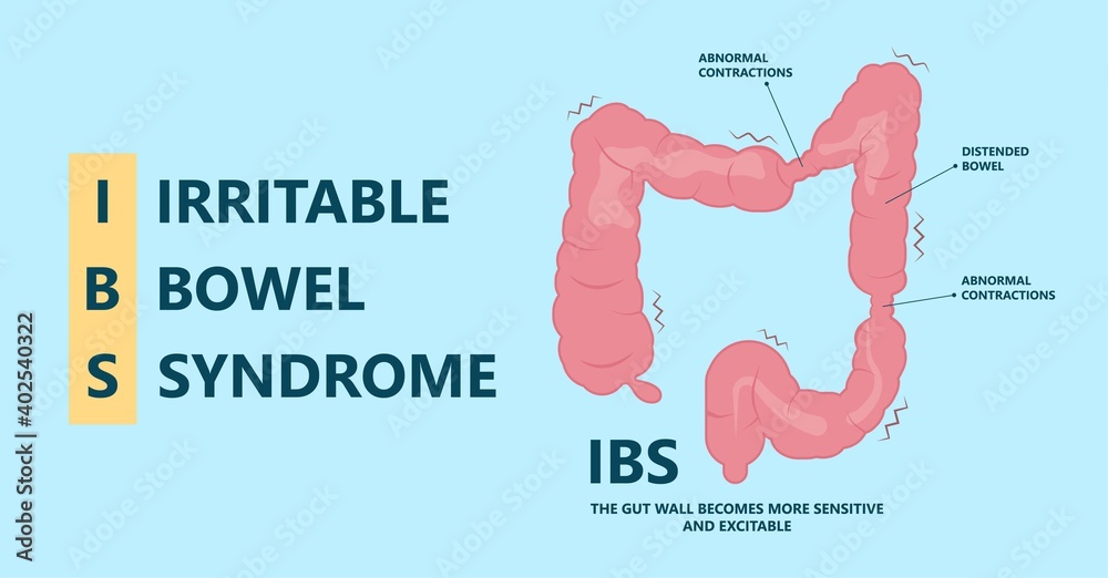 IBS large small pain gas treat cancer mucus stool colon Rectal tract ...