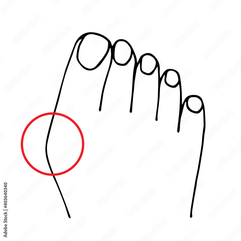 Simple vector black outline drawing. Hallux valgus, deformity of the ...