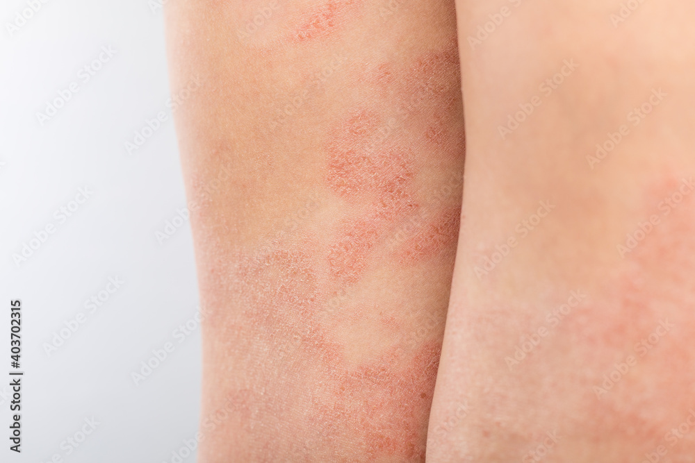 Photo Stock Acute atopic dermatitis on the legs behind the knees of a ...