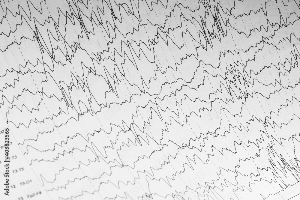 EEG wave form of the pediatric patients, problems in the electrical ...