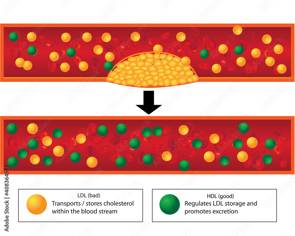 Role of good and bad lipids and levels of atherosclerotic plaque in ...