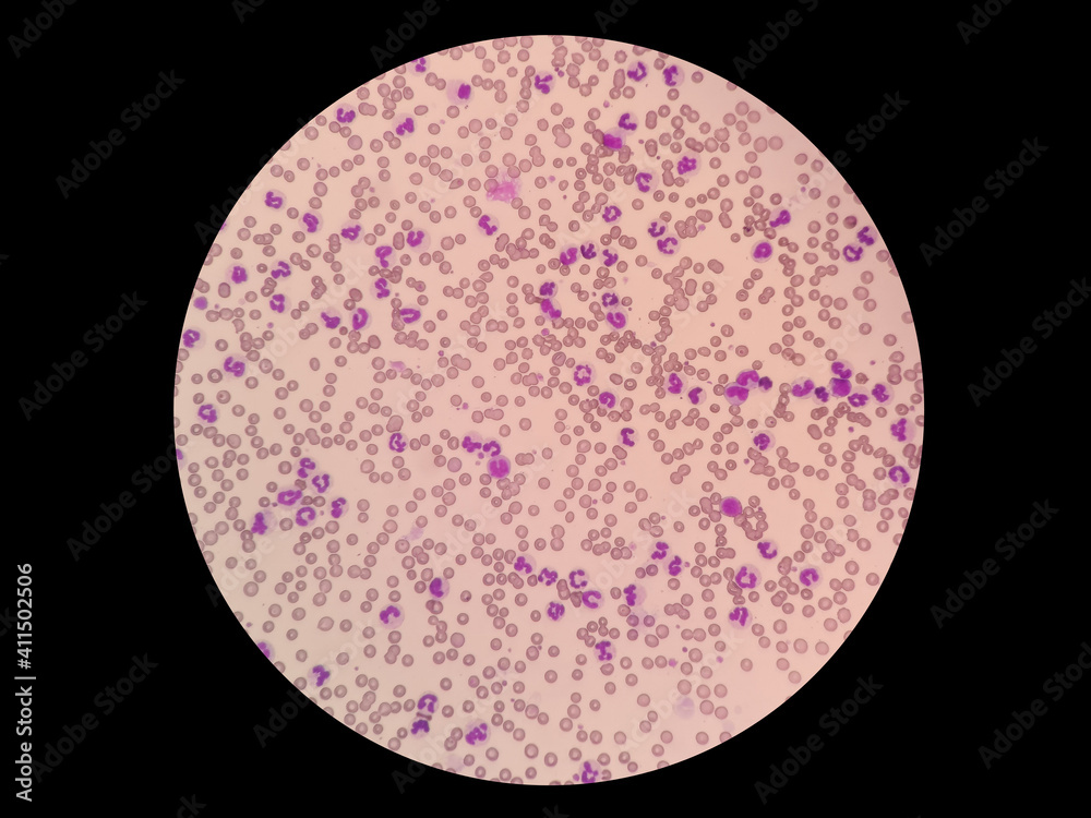 Leukemoid reaction describes an increased white blood cell count, or ...