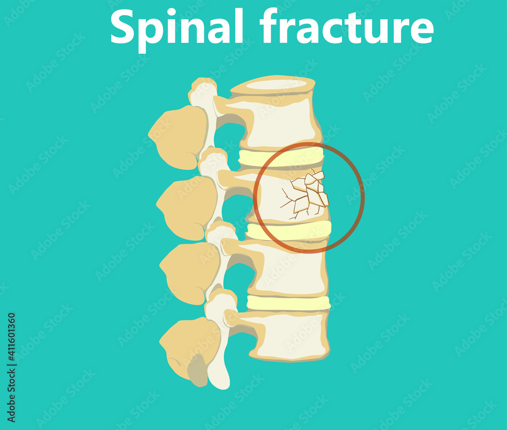 Spinal Disc Injury Vector Medical Scheme with Magnification of ...